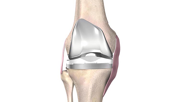 Knee Resurfacing Surgery - UChicago Medicine